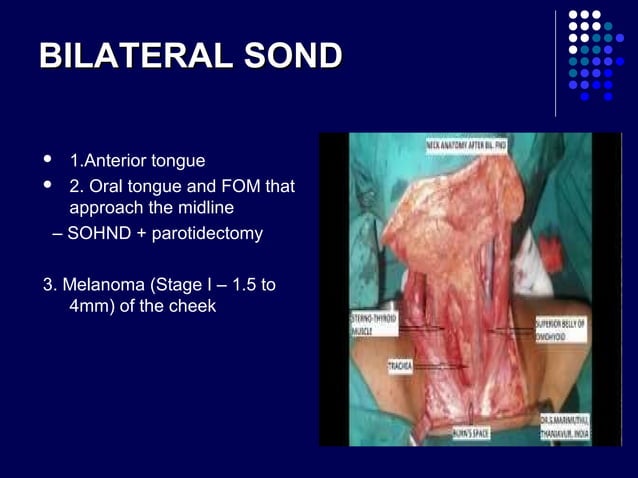 Neck Dissection.Overview | PPT | Thyroid Disorders | Endocrine and ...