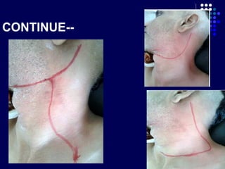 Neck Dissection.Overview | PPT