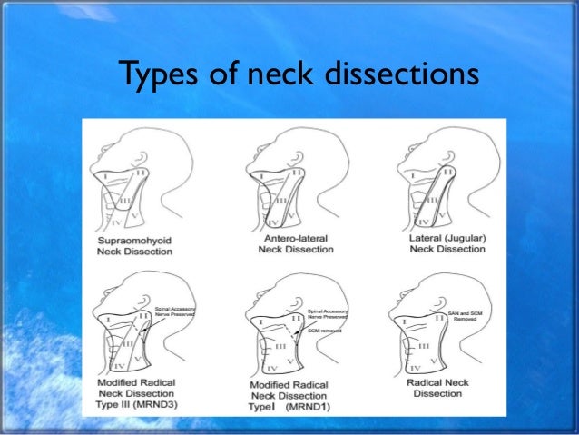 Neck dissection