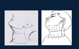 Neck dissection | PPT