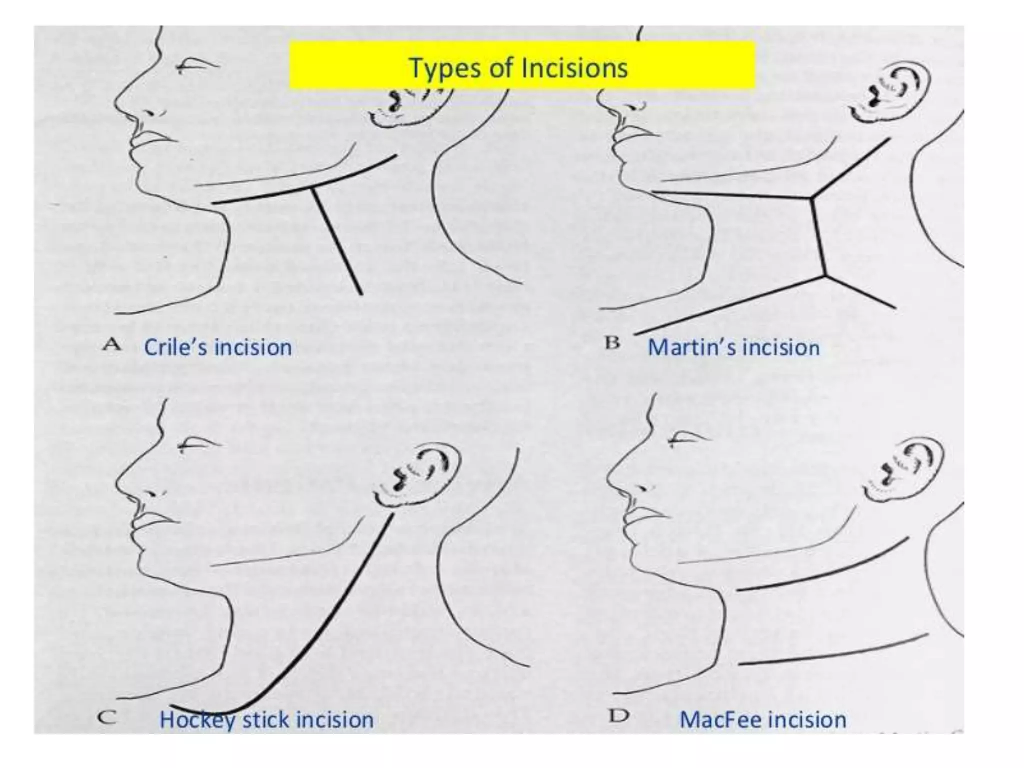 Neck dissection | PPTX