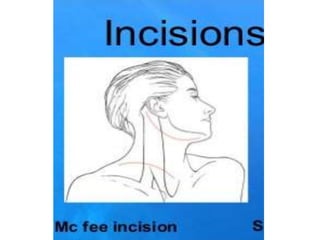 Neck dissection | PPTX