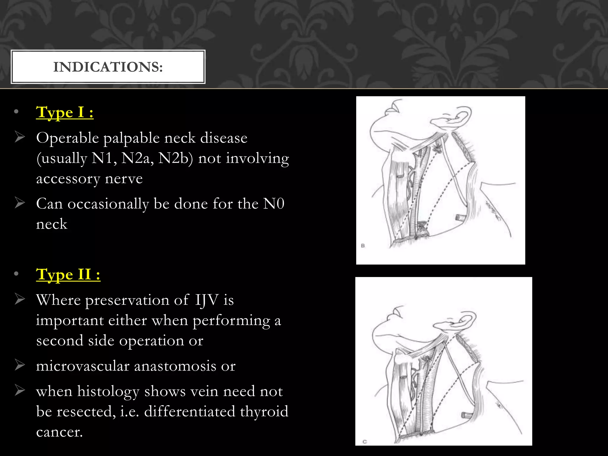 Neck dissection | PPTX