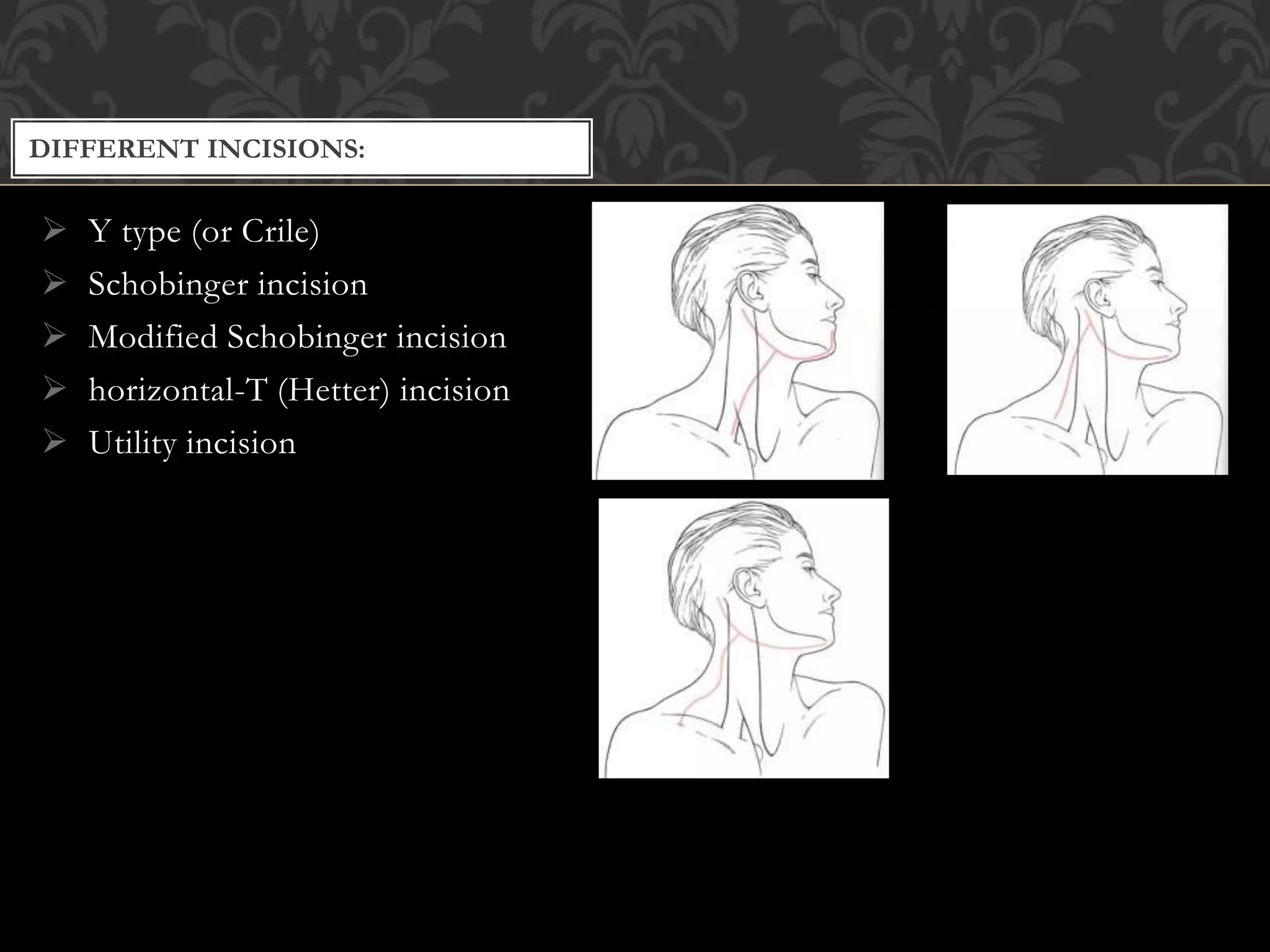 Neck dissection | PPTX