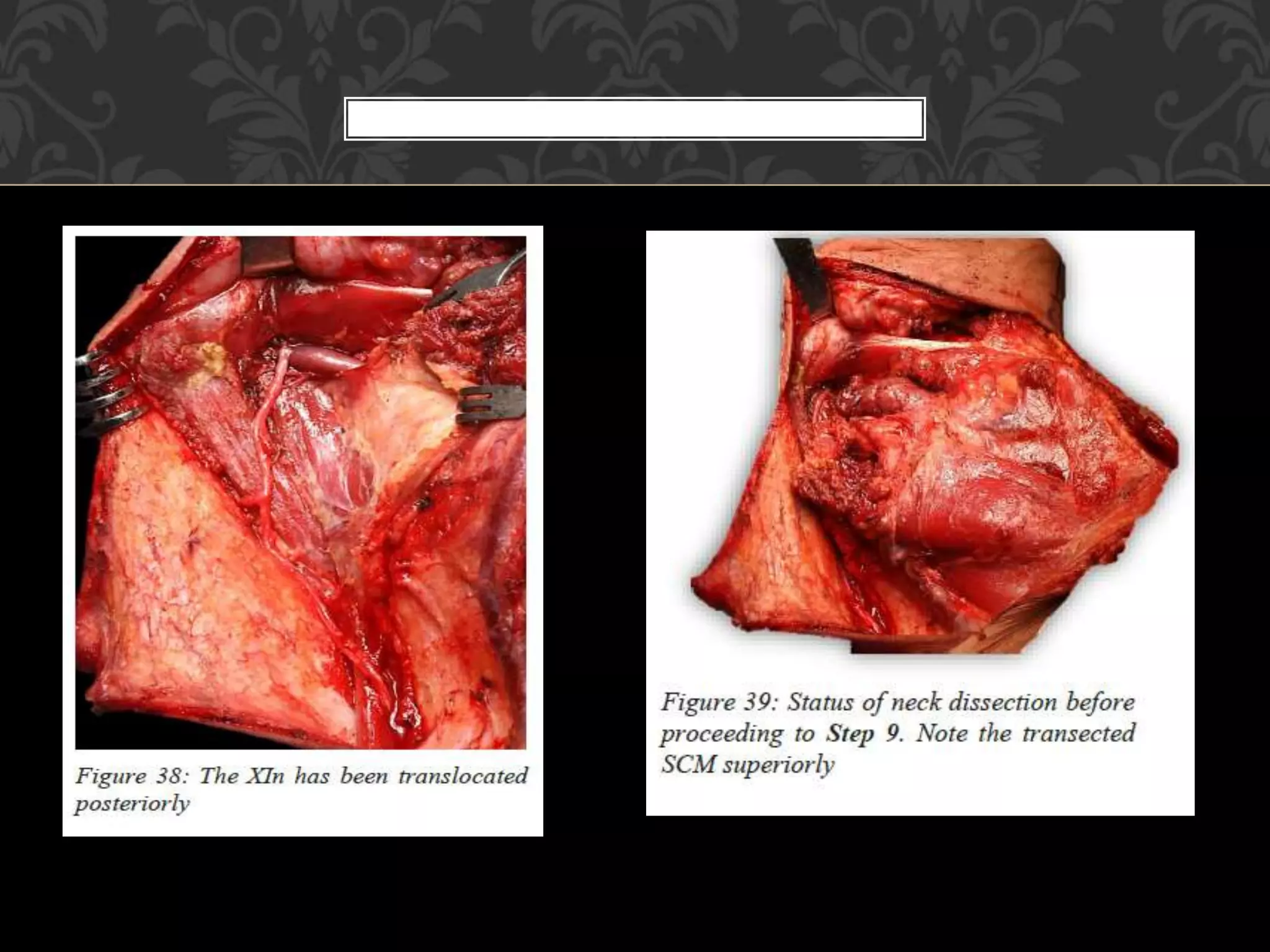 Neck dissection | PPTX