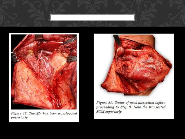 Neck dissection | PPTX