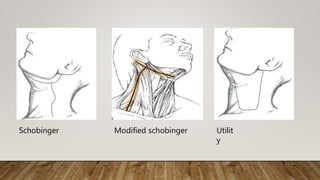 Neck dissection | PPTX
