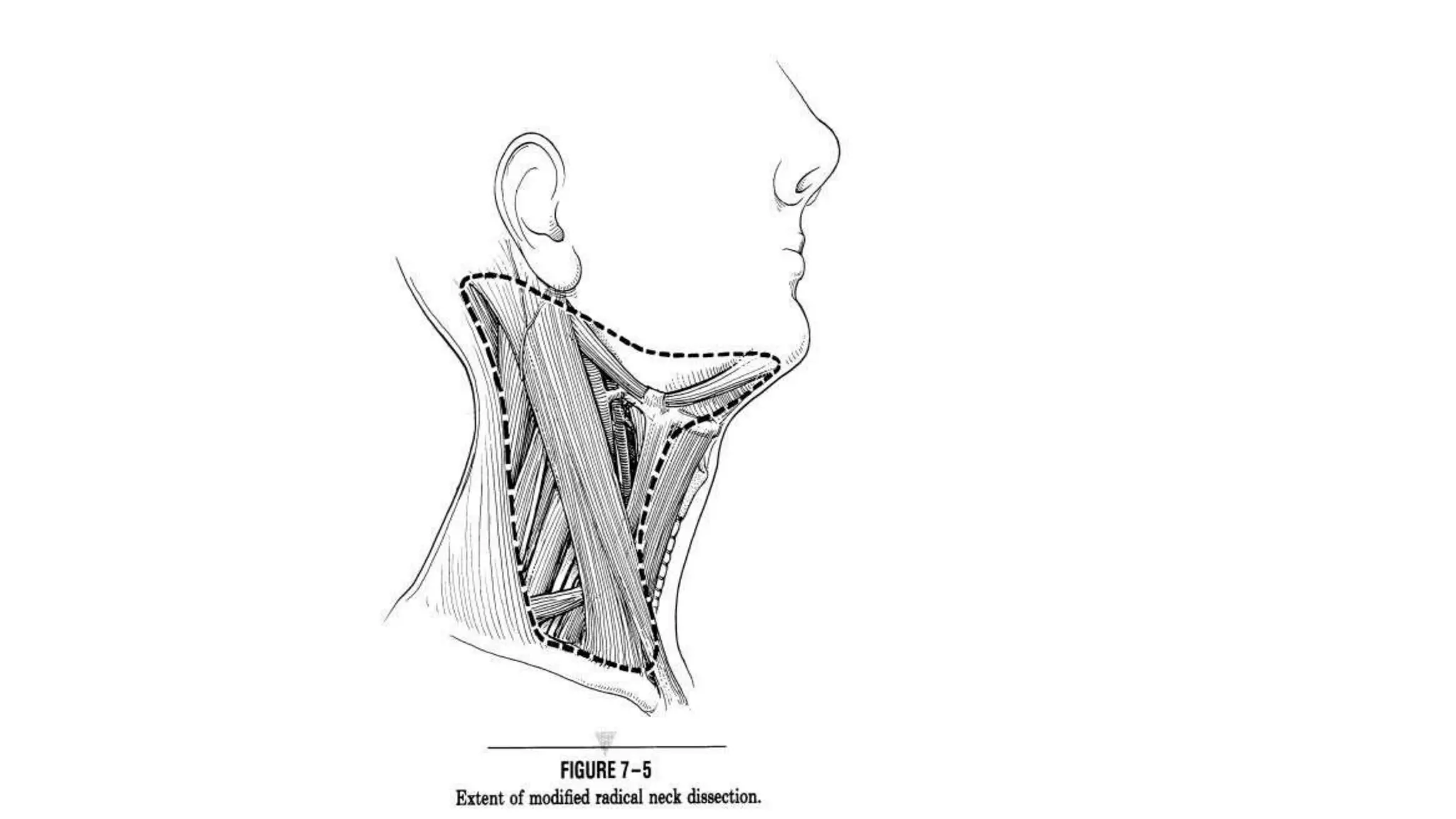 Neck Dissection.pptx