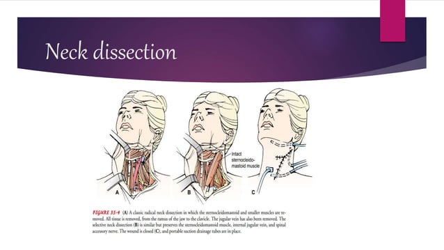 Neck dissection.pptx