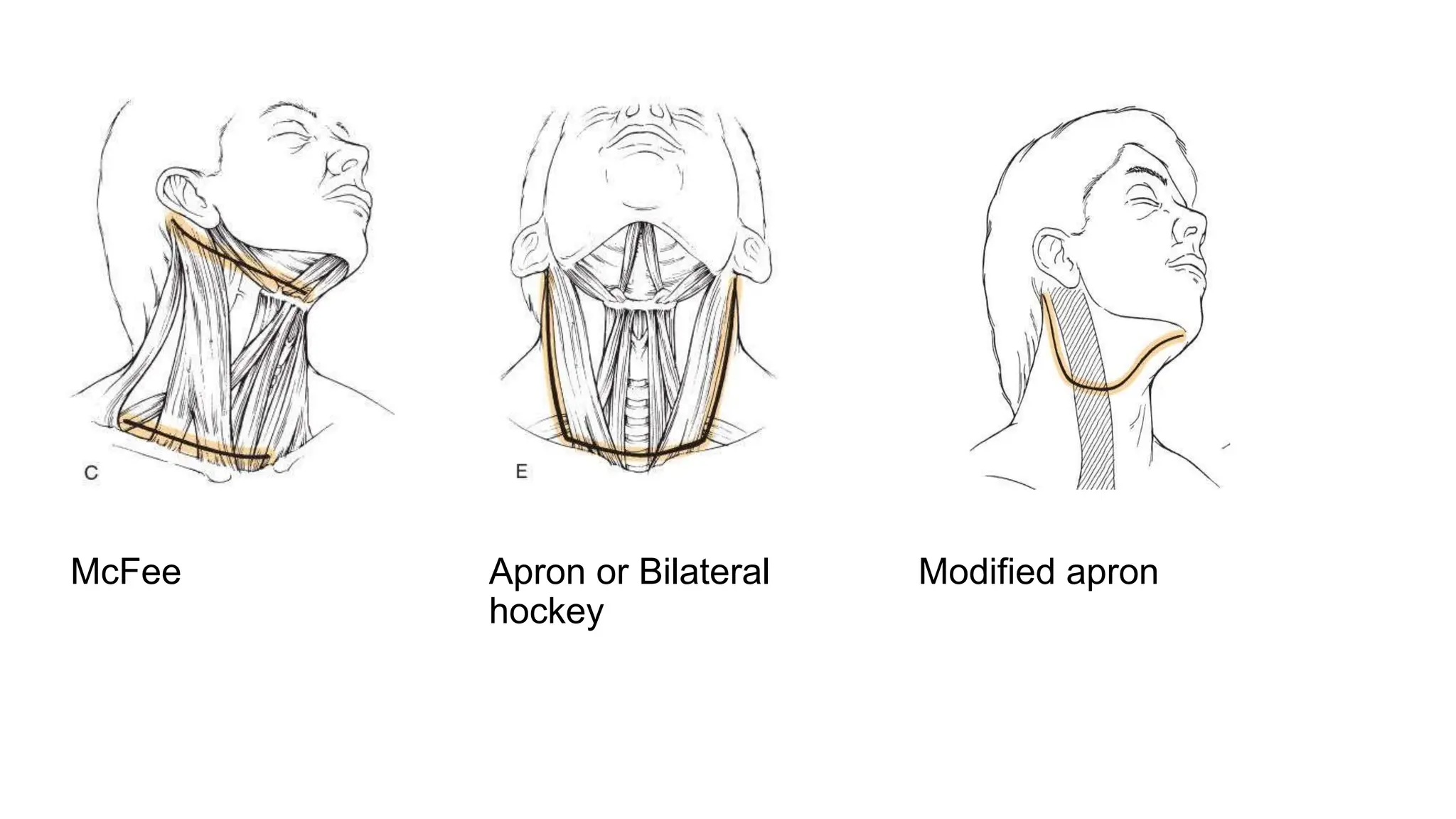 Neck Dissection Head Neck oncoSurgery.pptx