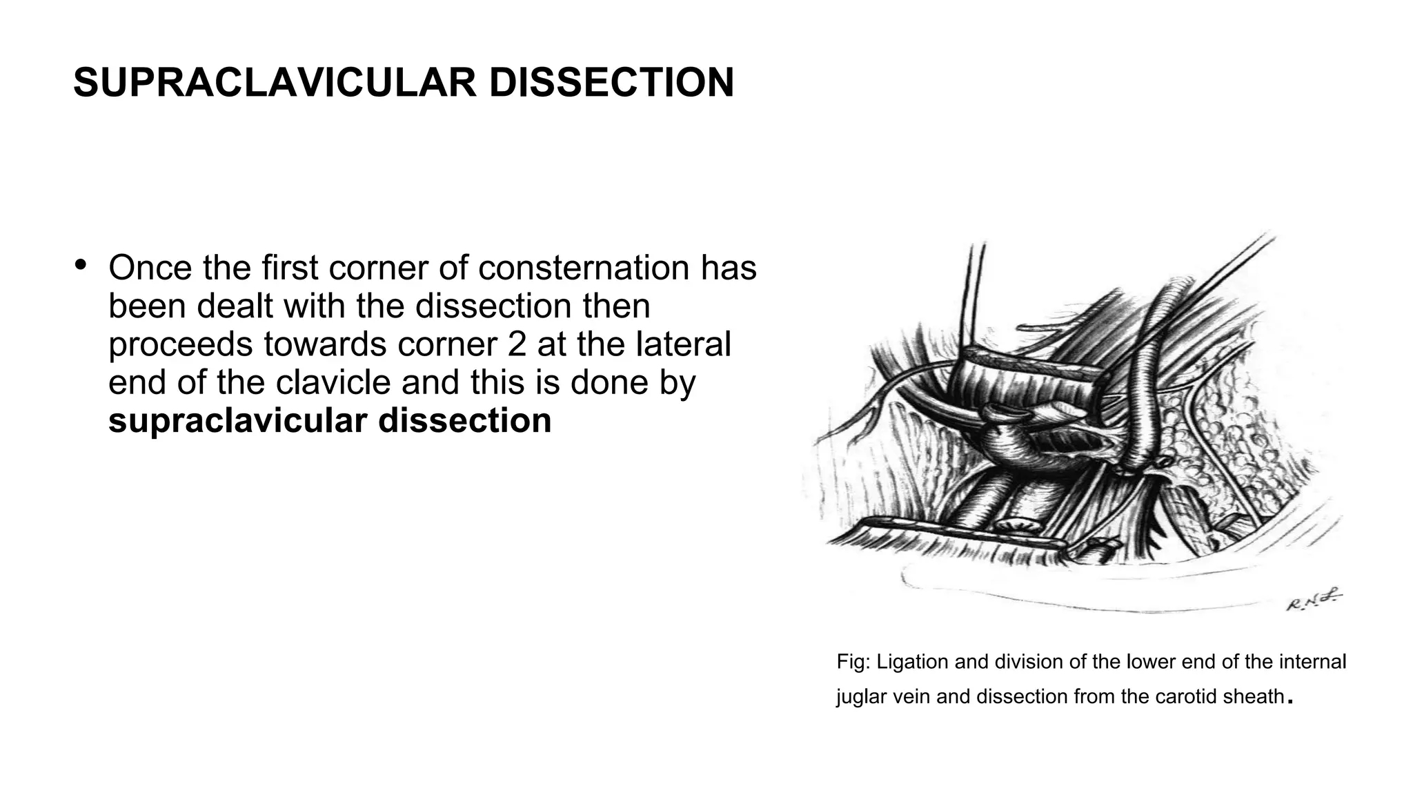 Neck Dissection Head Neck oncoSurgery.pptx