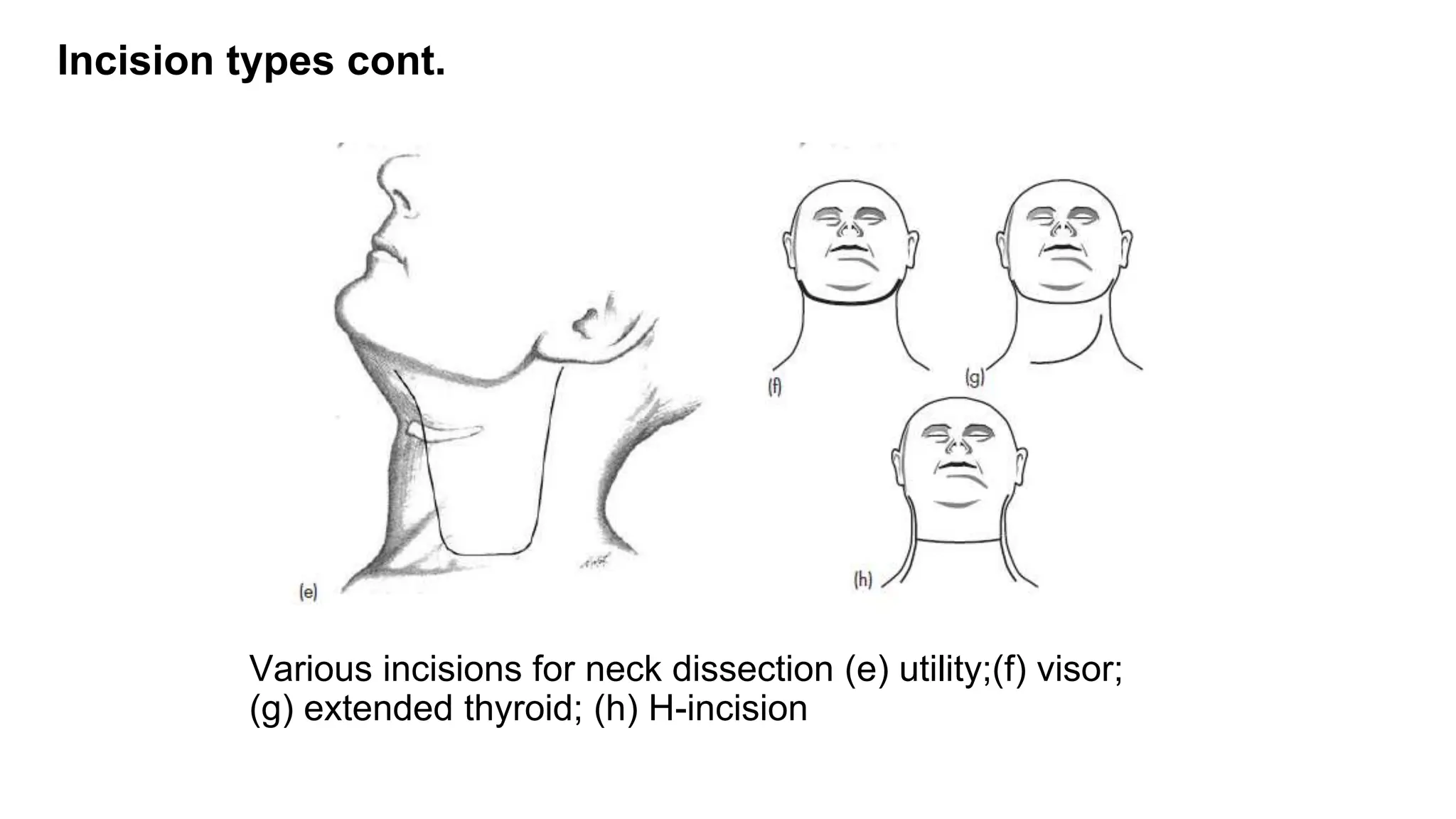 Neck Dissection Head Neck oncoSurgery.pptx