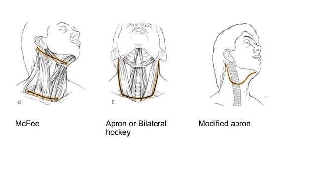 Neck Dissection Head Neck oncoSurgery.pptx | Death, Injury, or Military ...