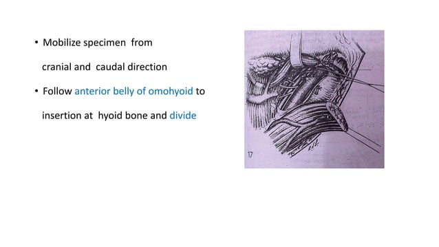 Neck Dissection Head Neck oncoSurgery.pptx | Death, Injury, or Military ...