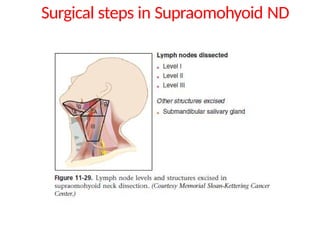 NECK DISSECTION-final (1).pptx Oral squamous cell carcinoma | PPTX