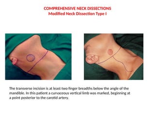 NECK DISSECTION-final (1).pptx Oral squamous cell carcinoma | PPTX