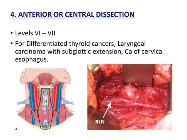 Neck dissection | PPTX