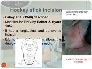 Neck dissection by dr akash rajput | PPTX