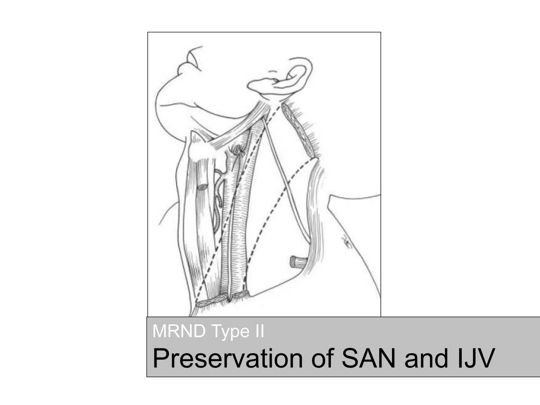 NECK DISSECTION- A COMPREHENSIVE STUDY | PPTX