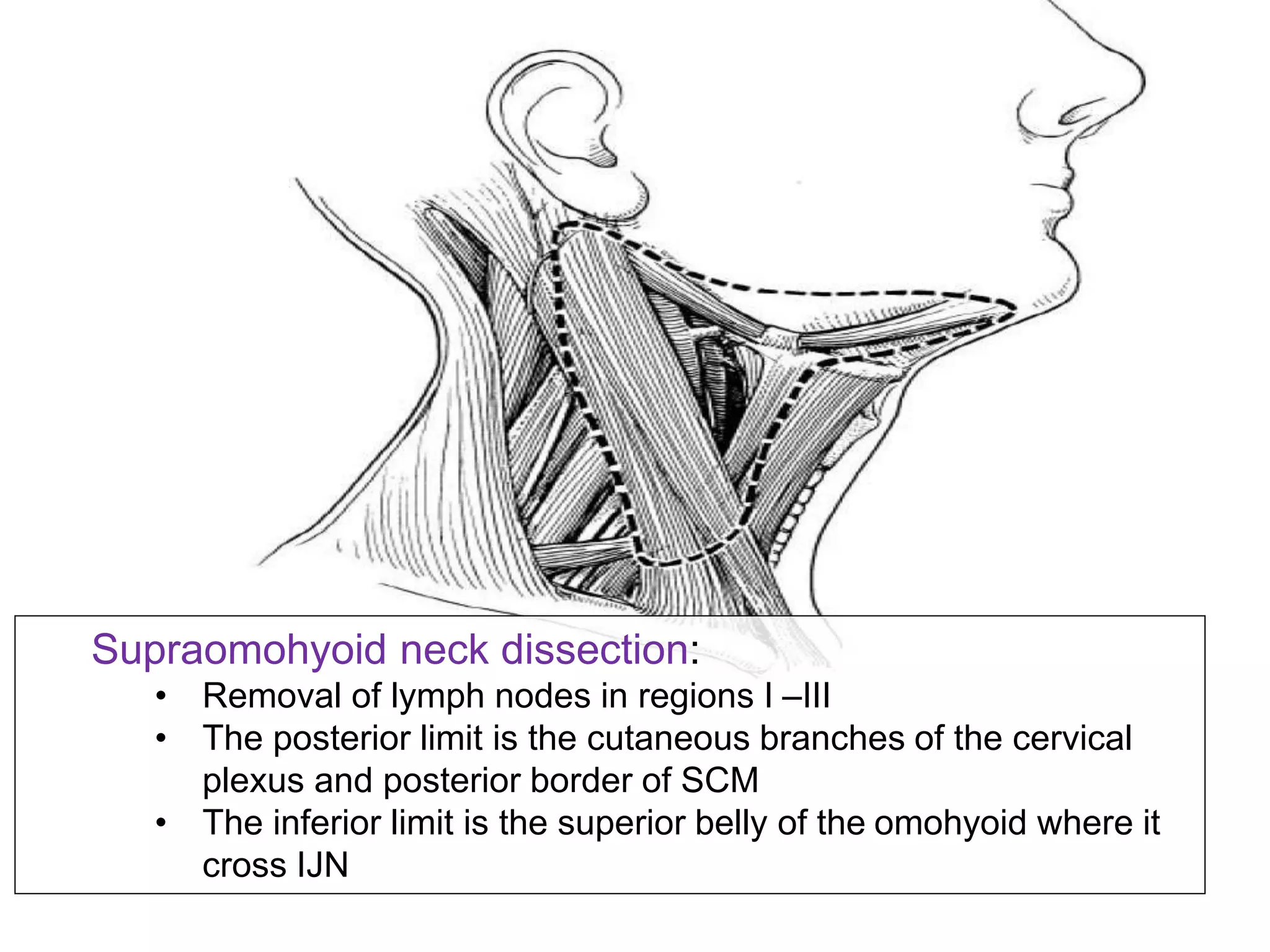 NECK DISSECTION- A COMPREHENSIVE STUDY | PPTX