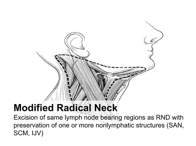 NECK DISSECTION- A COMPREHENSIVE STUDY | PPTX | Thyroid Disorders ...