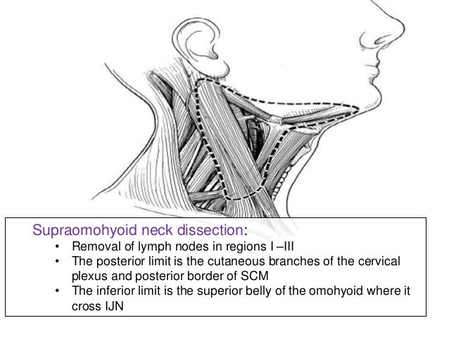 Suboccipital Lymph Node Case Example 2 Posterolateral Neck Dissection
