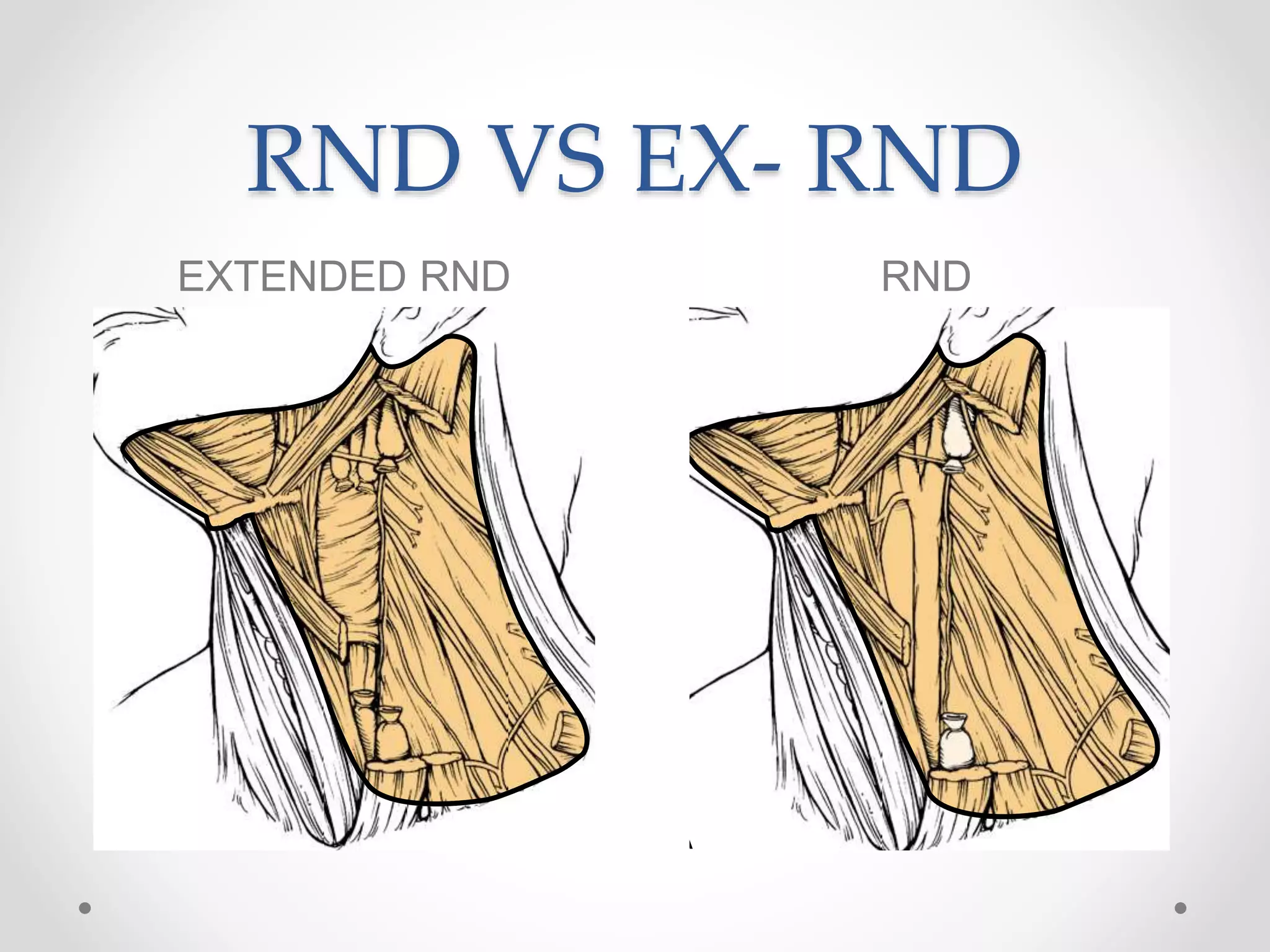 Neck dissection & local flap IN HNSCC | PPT