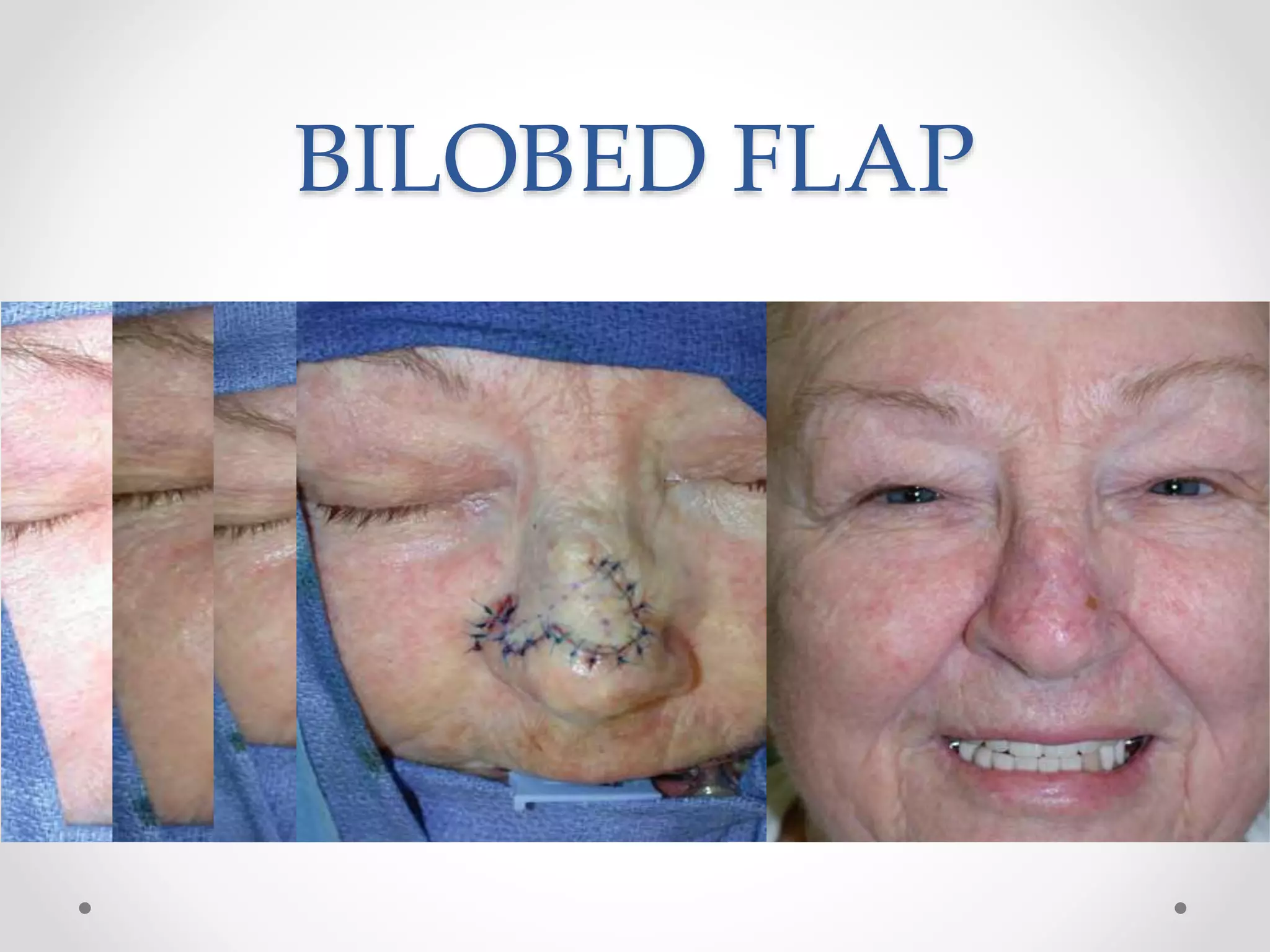 Neck dissection & local flap IN HNSCC | PPT