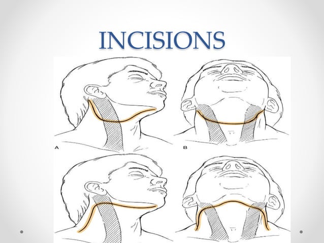 Neck dissection & local flap IN HNSCC | PPT