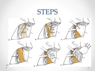 Neck dissection & local flap IN HNSCC | PPTX