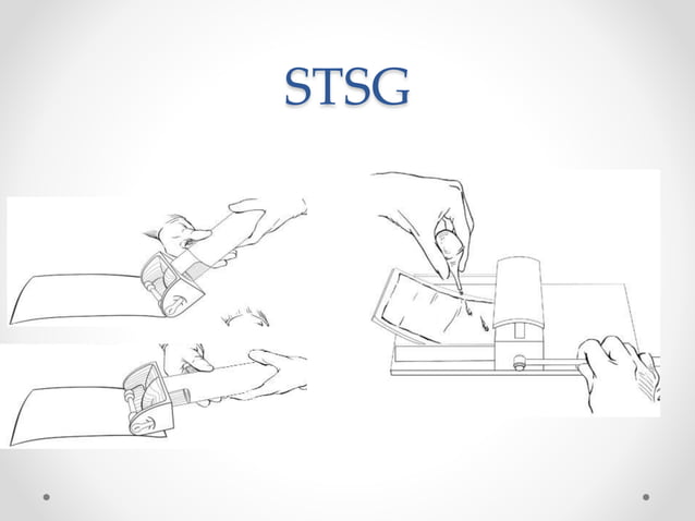 Neck dissection & local flap IN HNSCC | PPT
