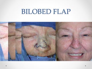 Neck dissection & local flap IN HNSCC | PPT