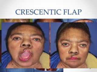 Neck dissection & local flap IN HNSCC | PPTX