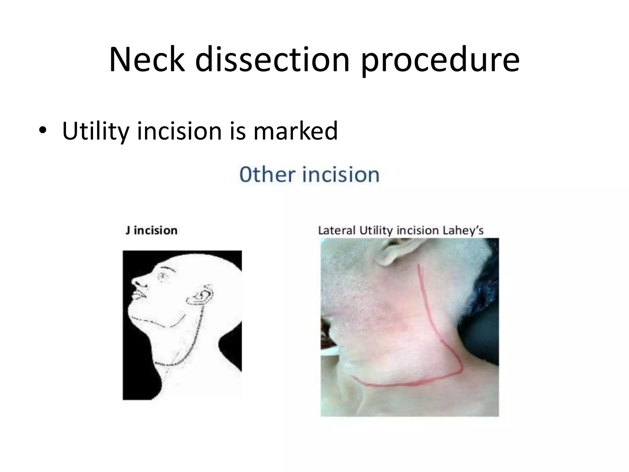 Neck dissection procedure | PPTX