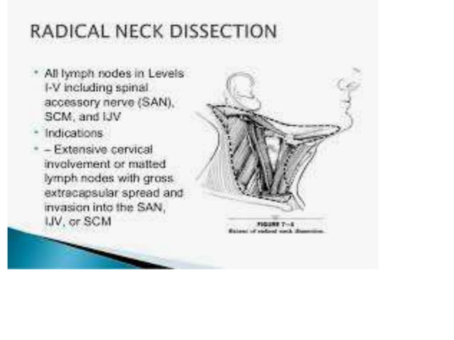 Neck dissection procedure | PPTX
