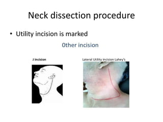 Neck dissection procedure | PPTX