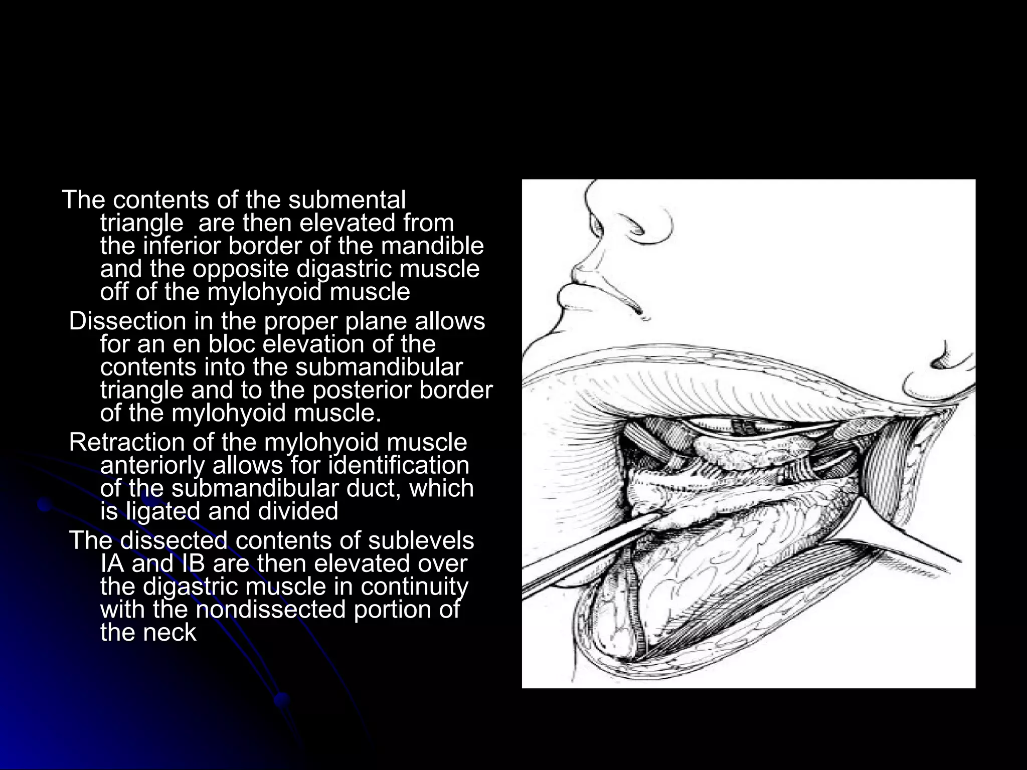 Neck Dissections | PPT