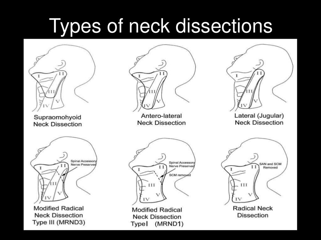 Neck Dissections