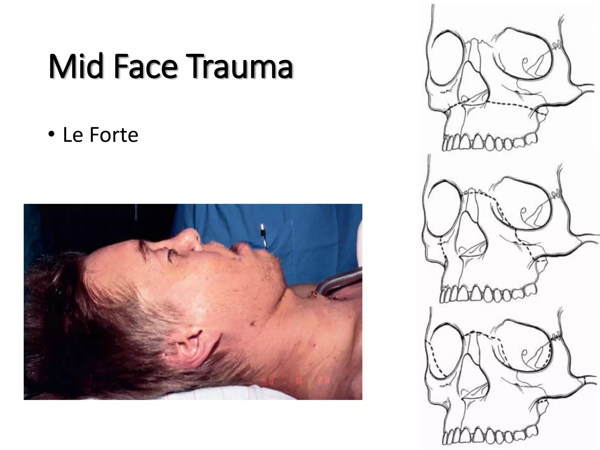 Neck & Facial trauma | PPTX