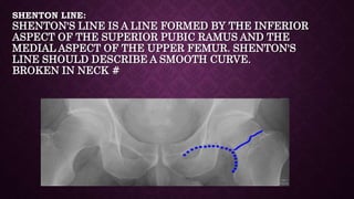 Fracture Neck of Femur | PPT