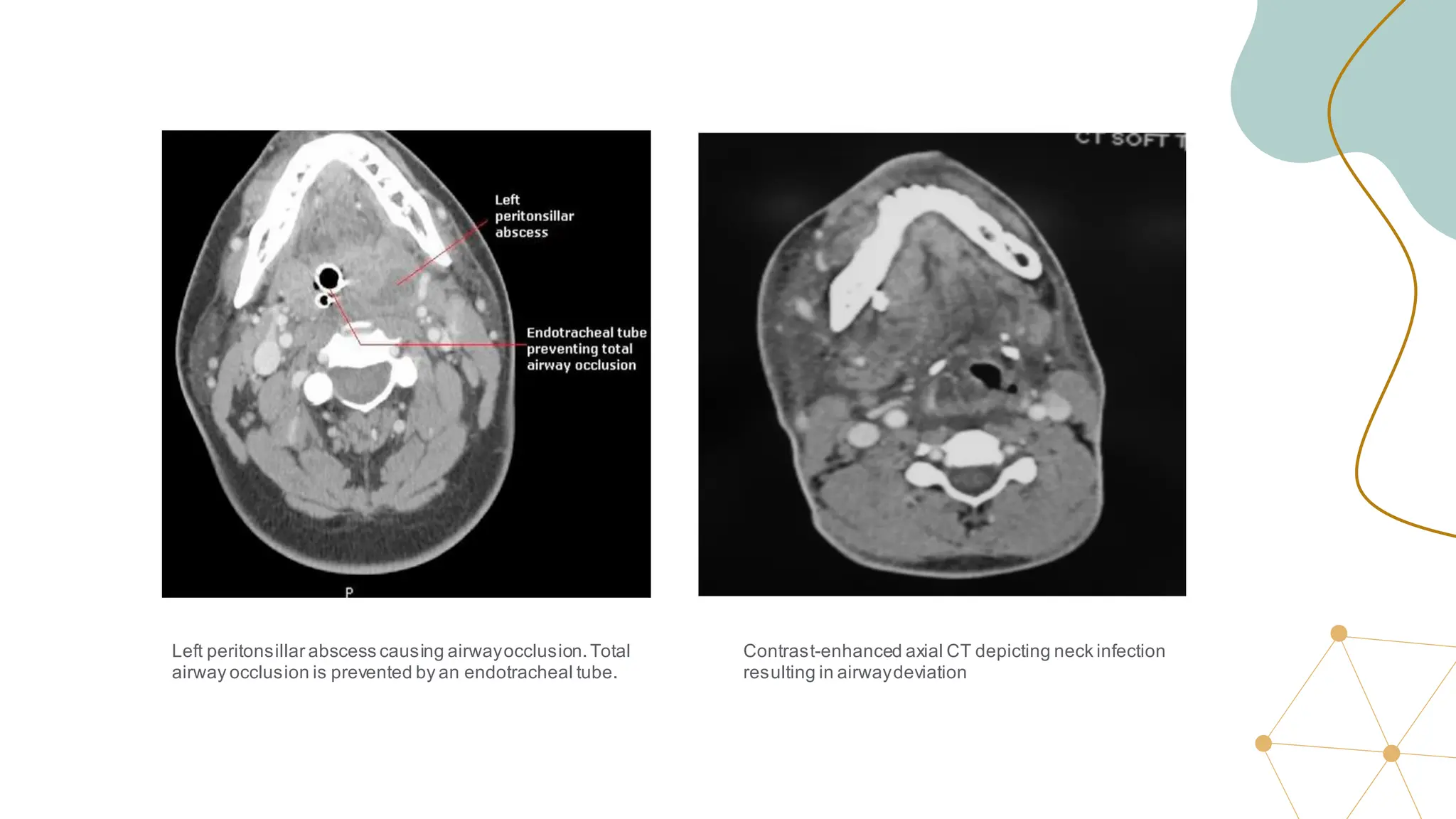neck infections - neck infections neck infection | PDF