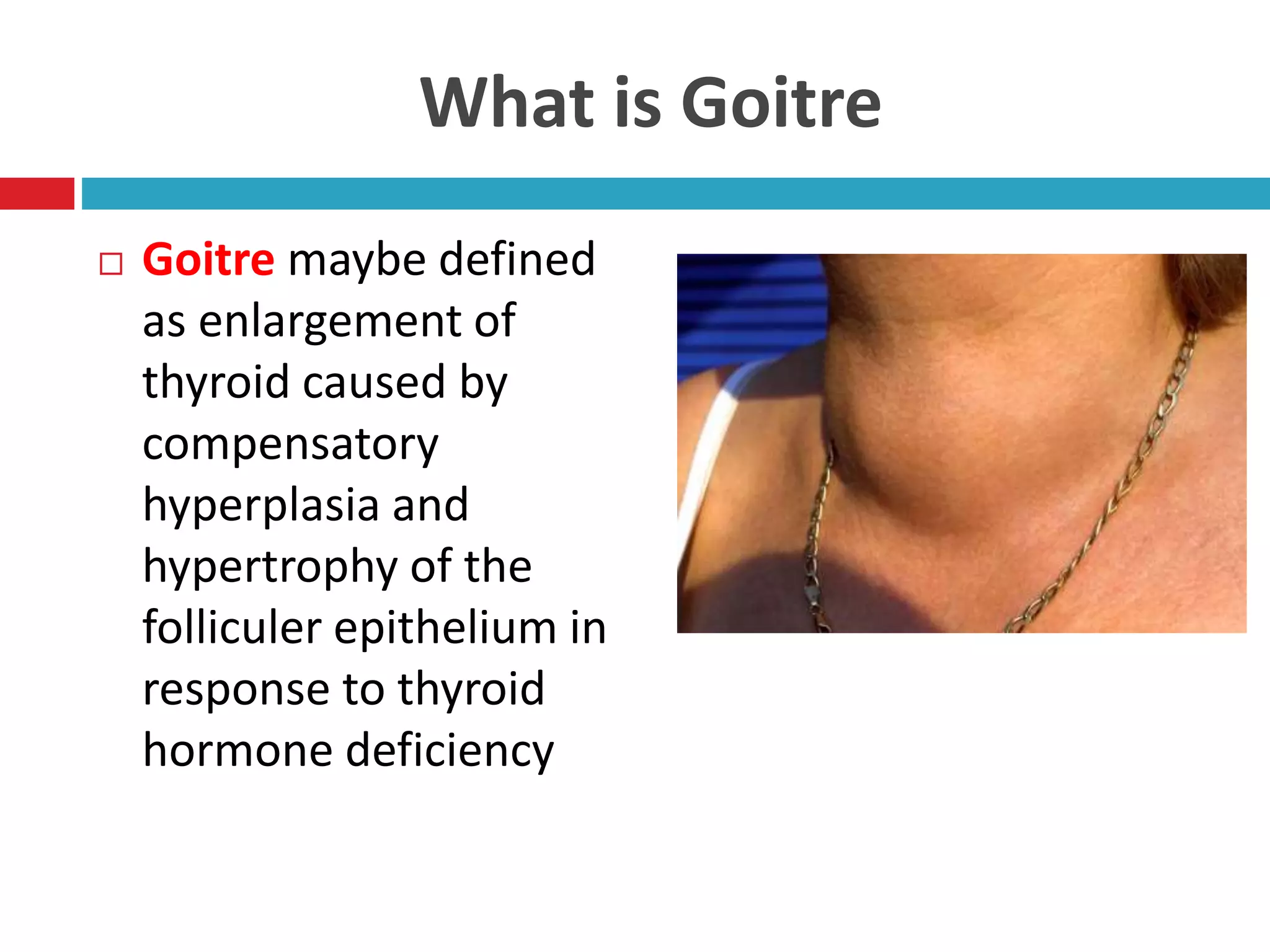 Neck Lump - A Case of Nodular Goitre | PPTX