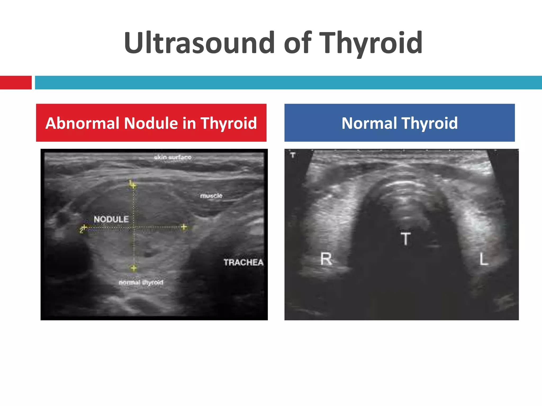 Neck Lump - A Case of Nodular Goitre | PPTX