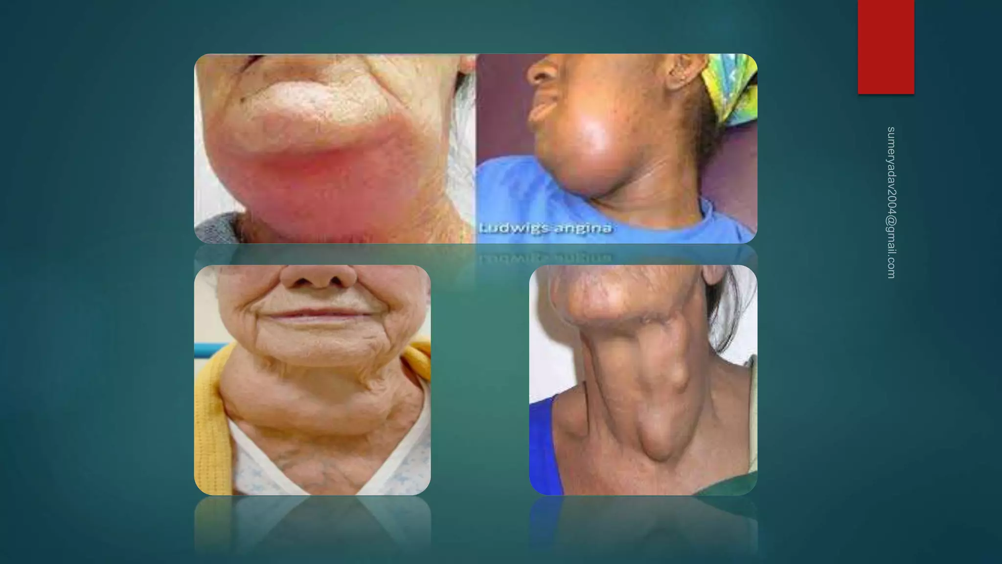 Neck mass differential diagnosis | PPTX