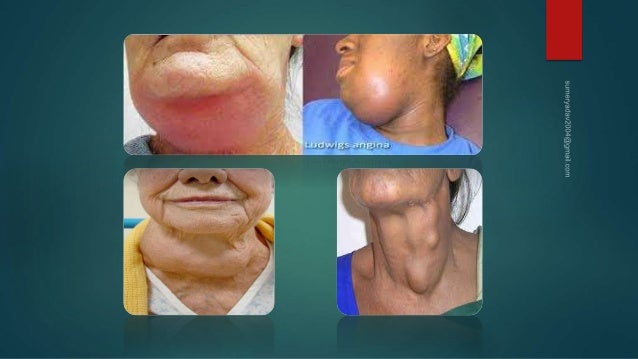 Neck Mass Differential Diagnosis
