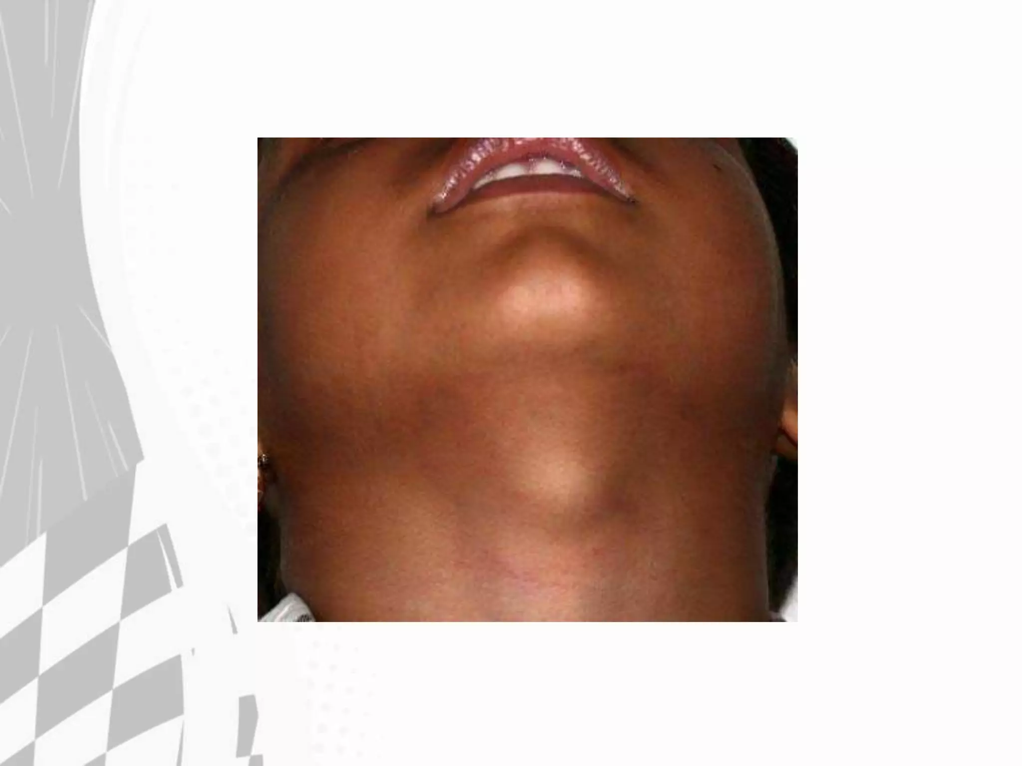 Neck masses in children | PPTX