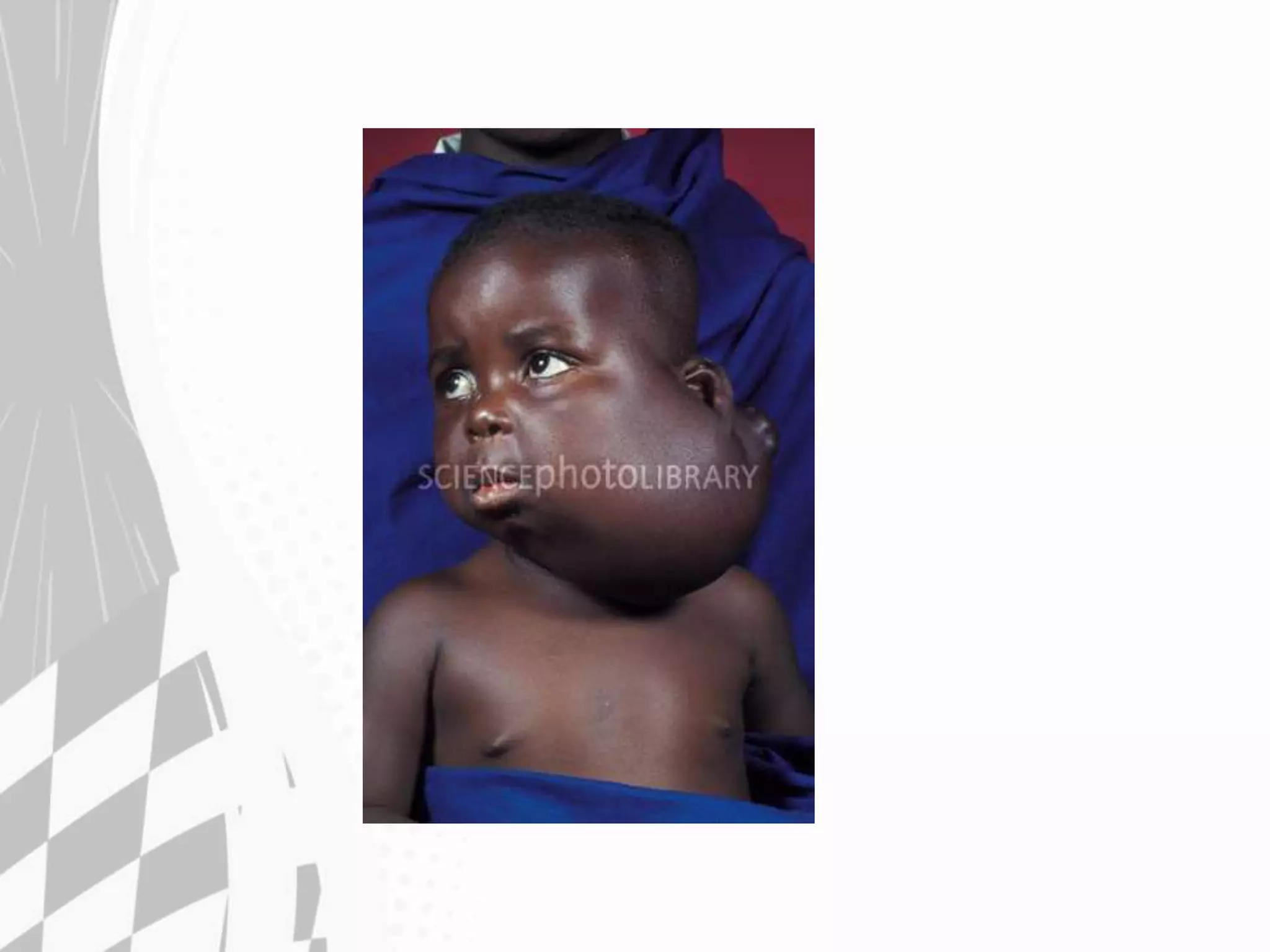 Neck masses in children | PPTX