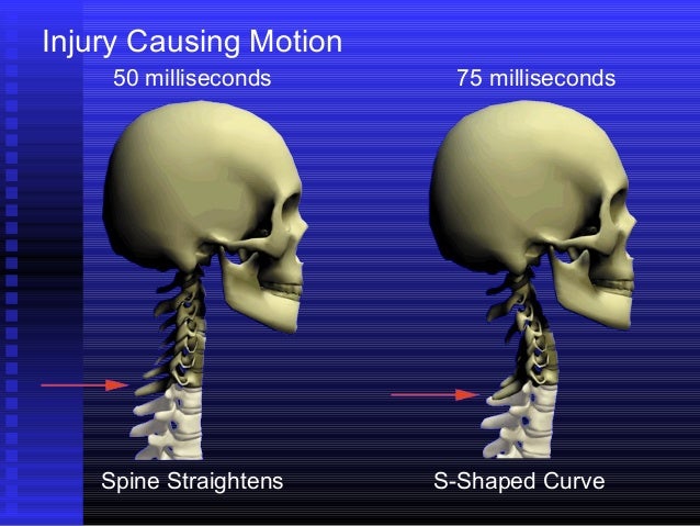 Rear Impact Neck Injury