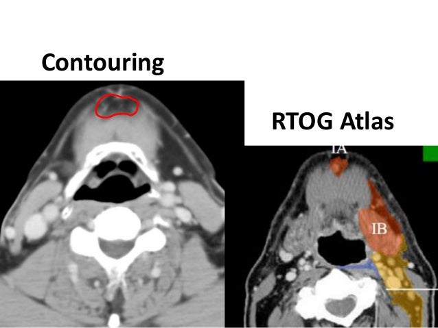 Neck node & Contouring Guidelines