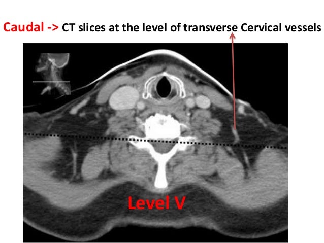 Neck node & Contouring Guidelines